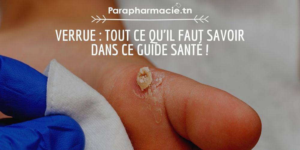 Verrue : Tout ce qu'il faut savoir dans ce guide santé ! | Parapharmacie.tn